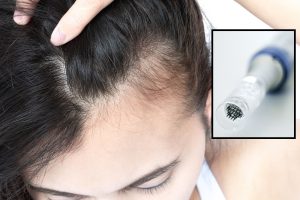 Scalp Microneedling Procedure Toronto