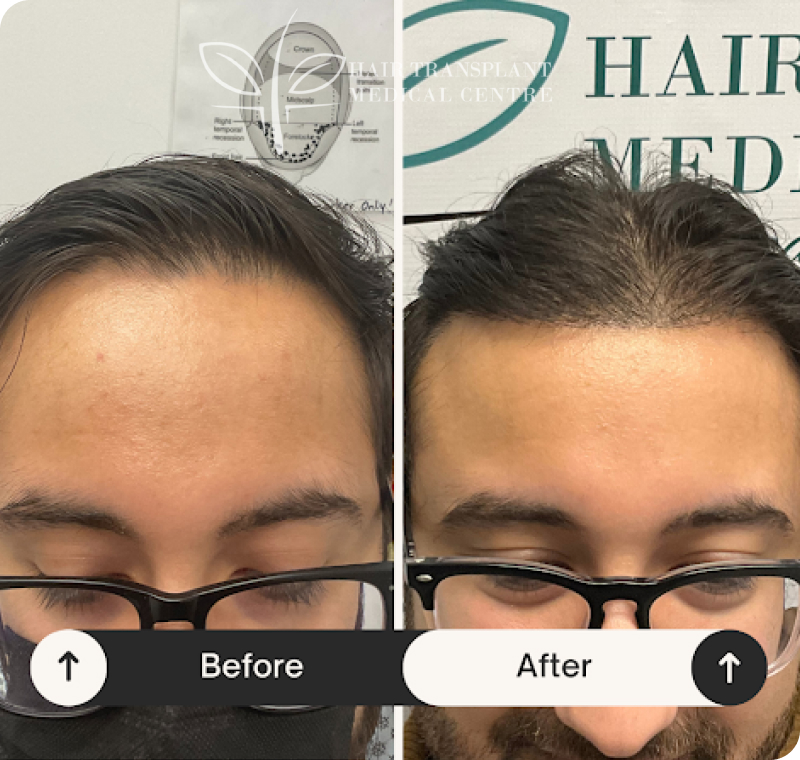 FUE Hair Transplant in Ontario: Benefits, Success Rate & What to Expect Before and After